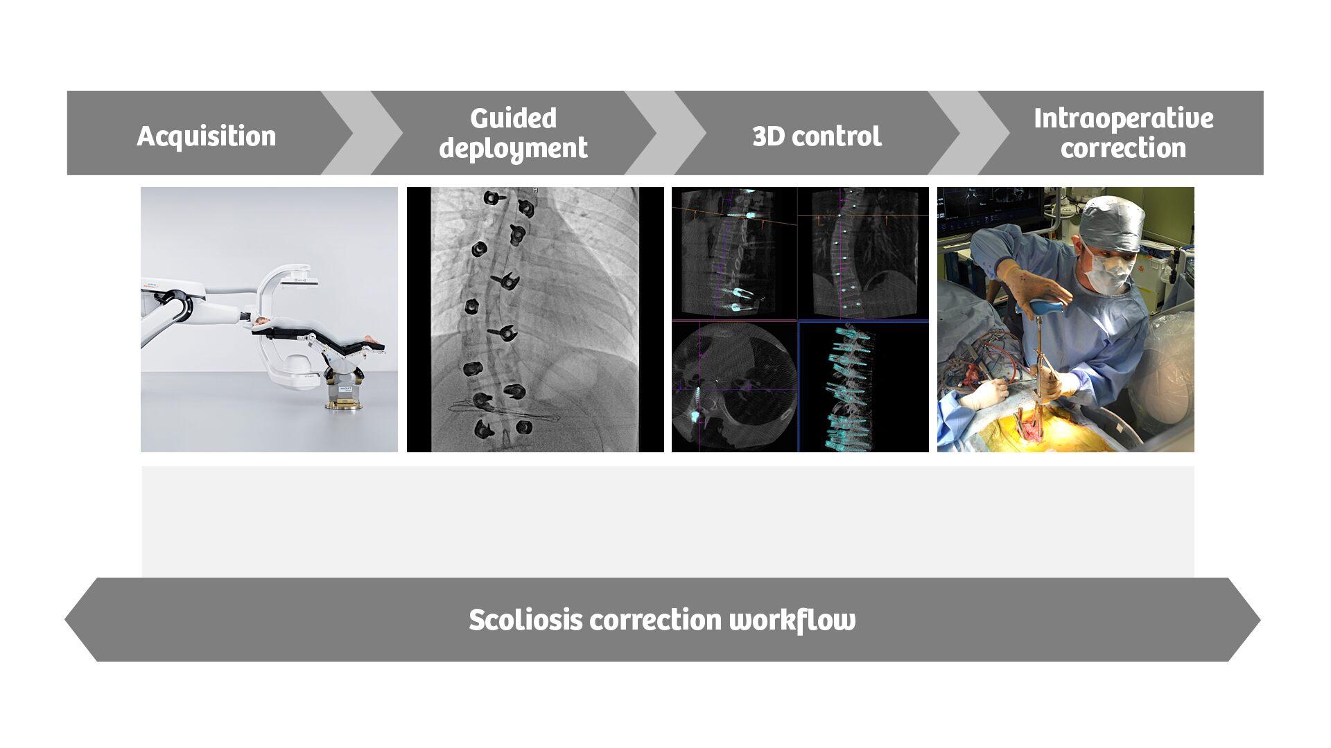Scoliosis Correction in the Hybrid OR