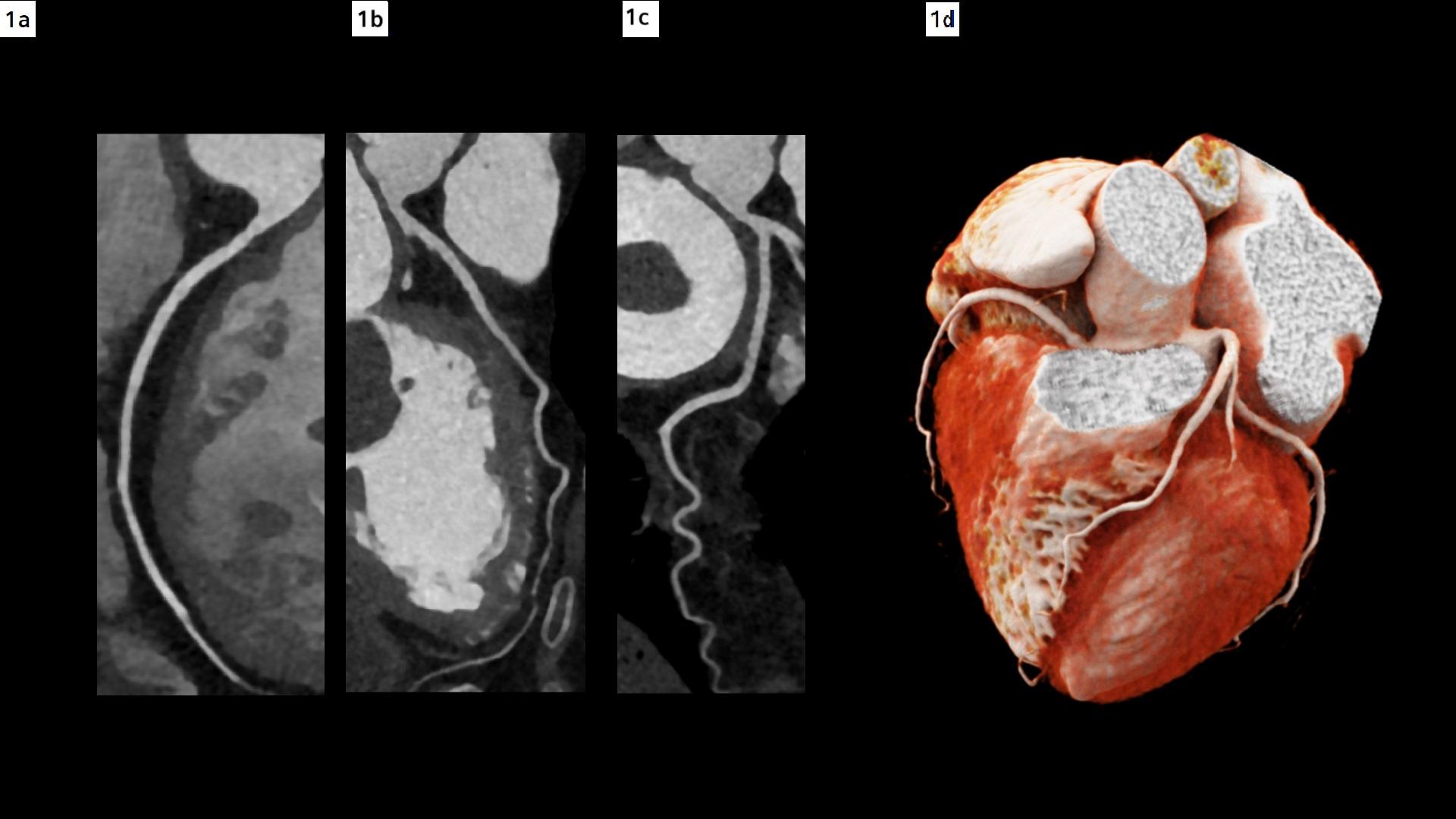 A mobile cardiac myxoma