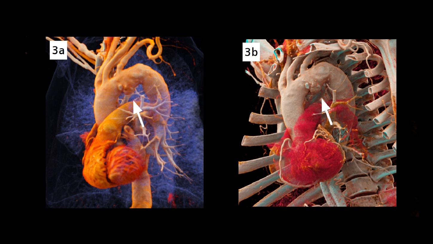 Complex thoracoabdominal aortic aneurysm – EVAR with renovisceral ...