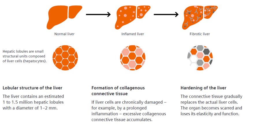 Liver fibrosis: Patients can be at risk of death even without ...