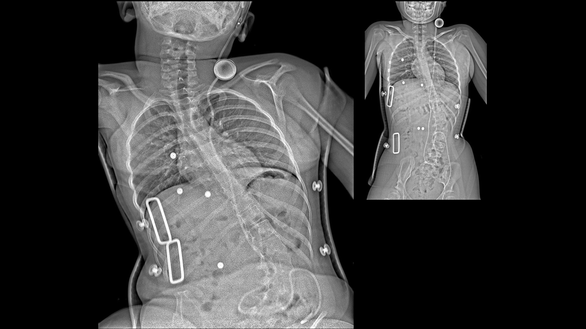 Twin Robotic X-ray scanner – Multitom Rax