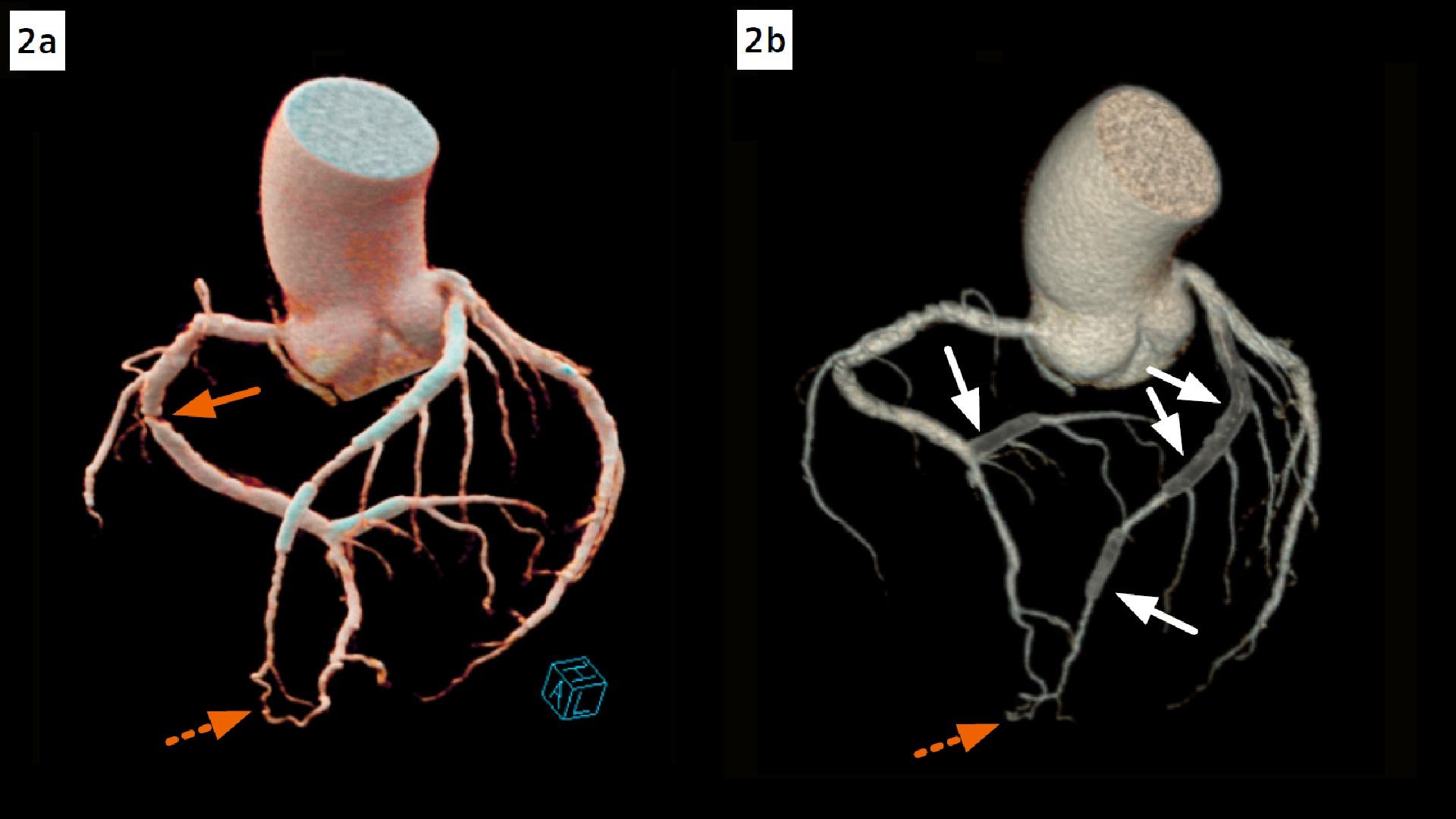 Triple-vessel coronary disease with multiple stents