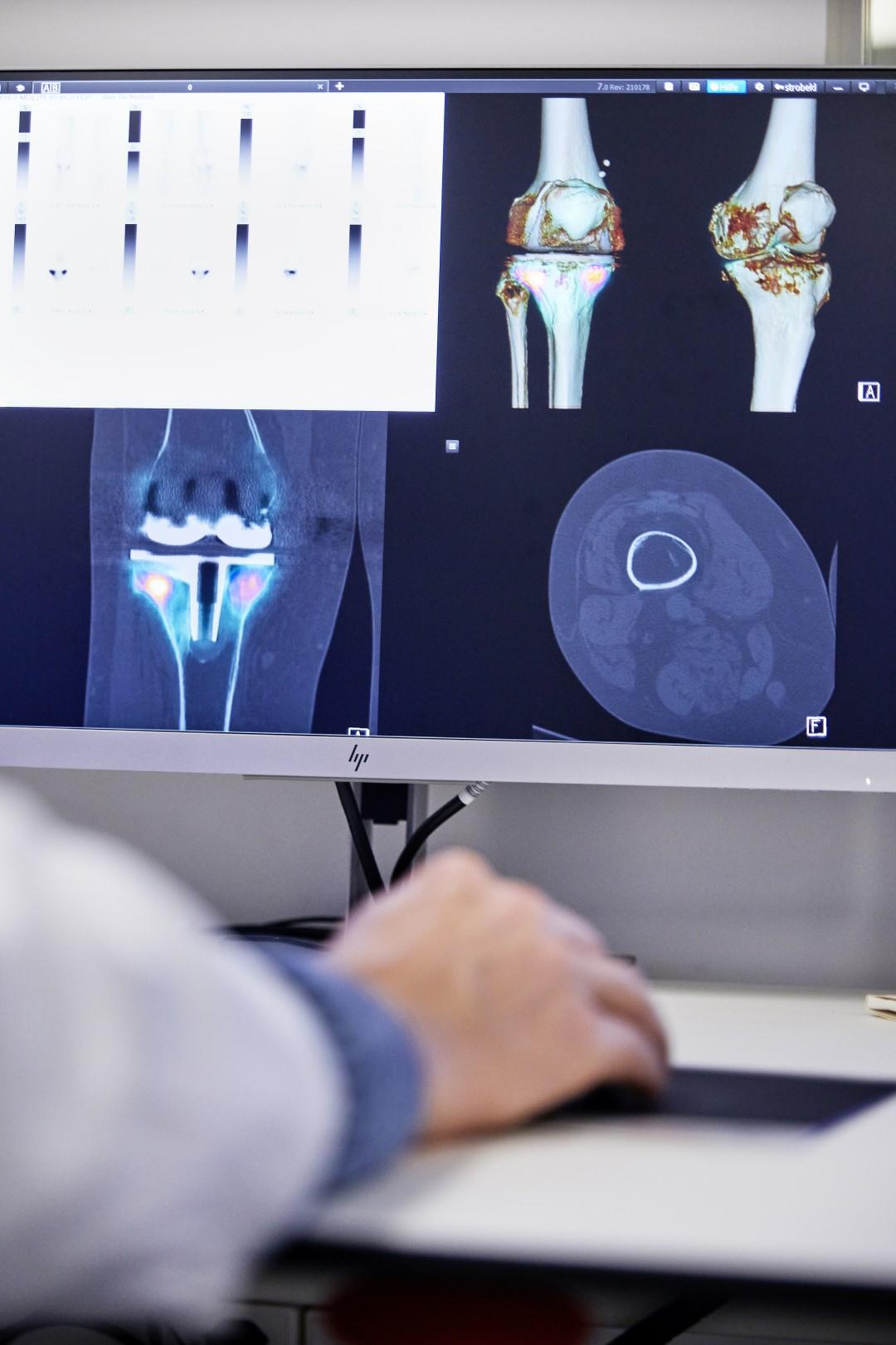 SPECT/CT Provides One-Stop Imaging