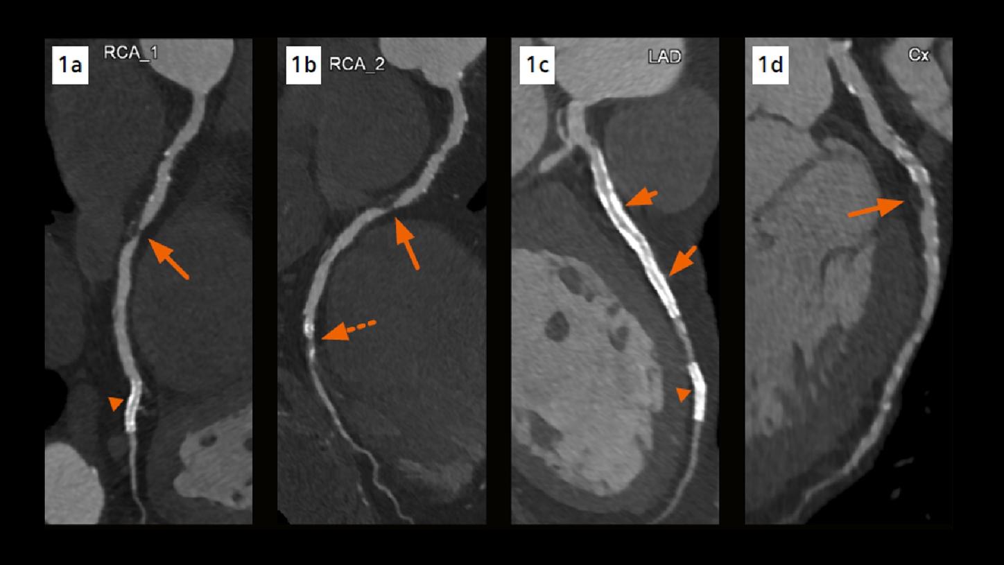 Triple-vessel coronary disease with multiple stents