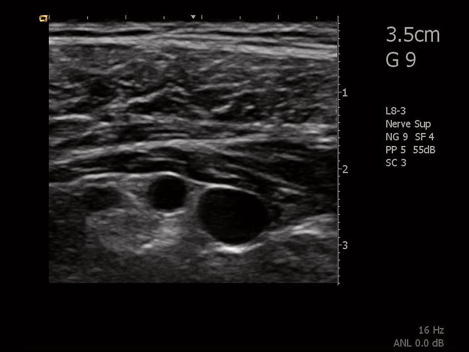 Wireless Ultrasound Transducers | ACUSON Freestyle