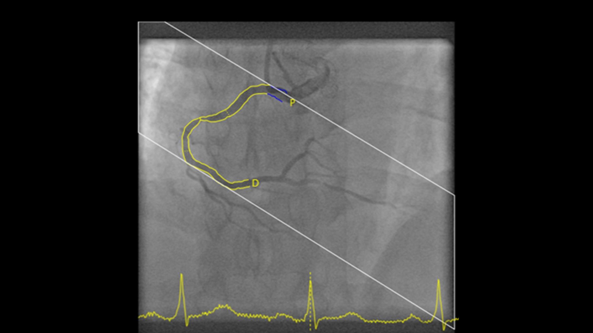 Rethink FFR assessment for every patient