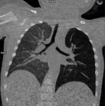 Pediatric Computed Tomography Solutions