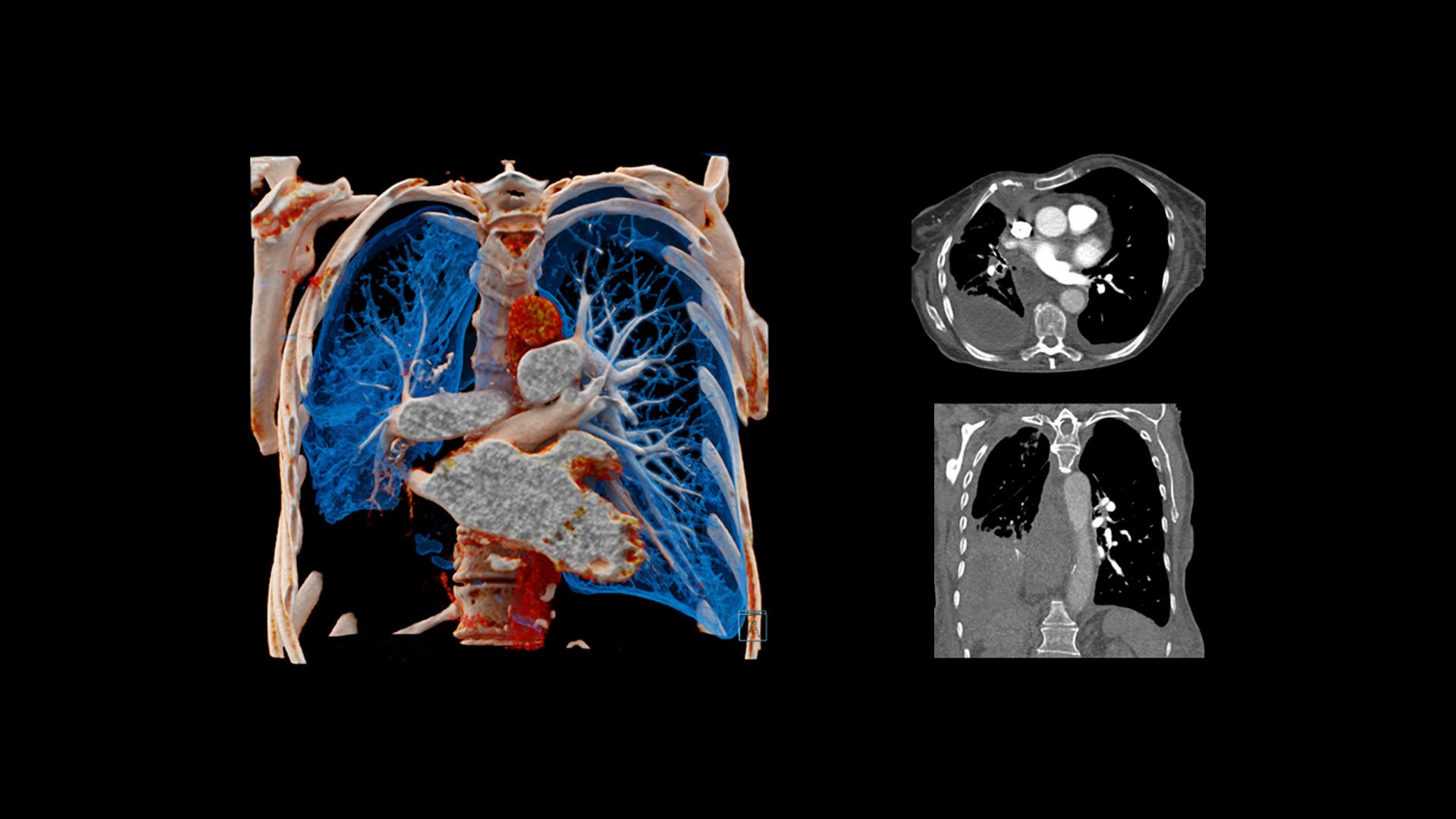 SOMATOM Definition Edge