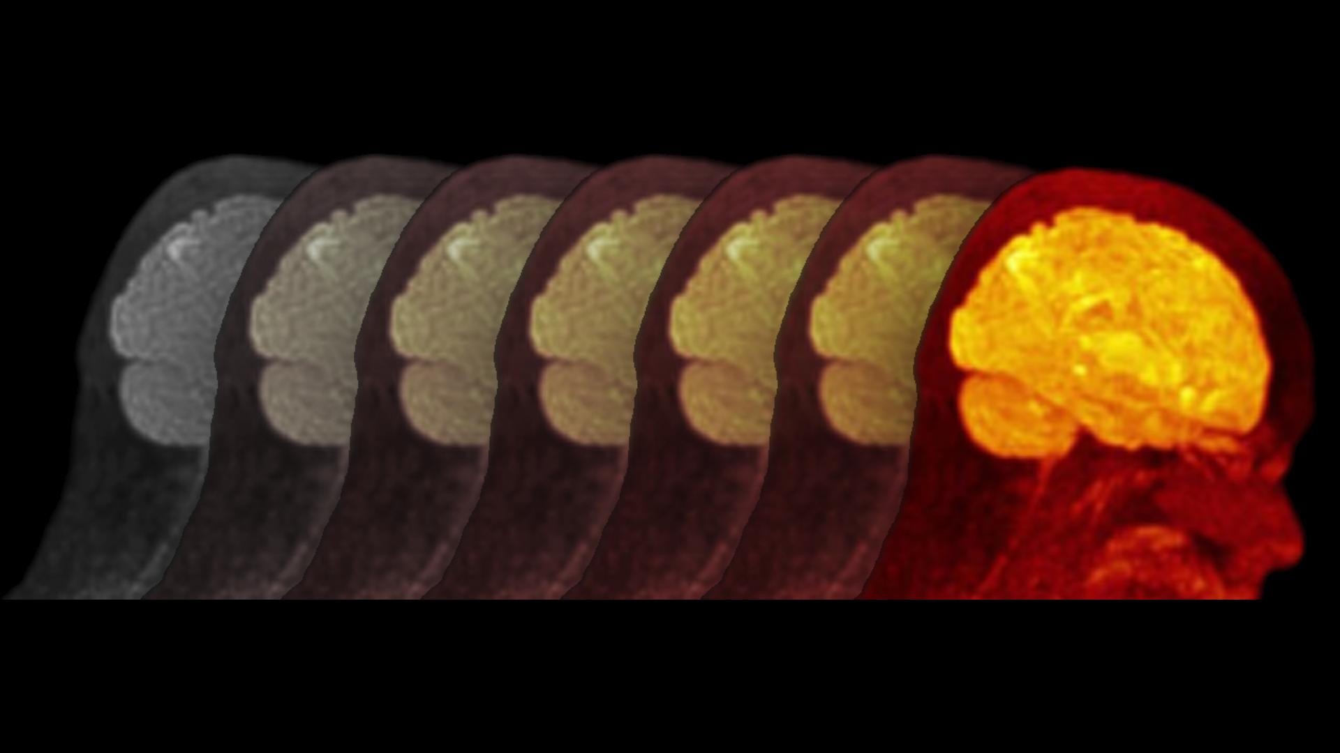 Siemens Healthineers PET imaging for Alzheimer's disease