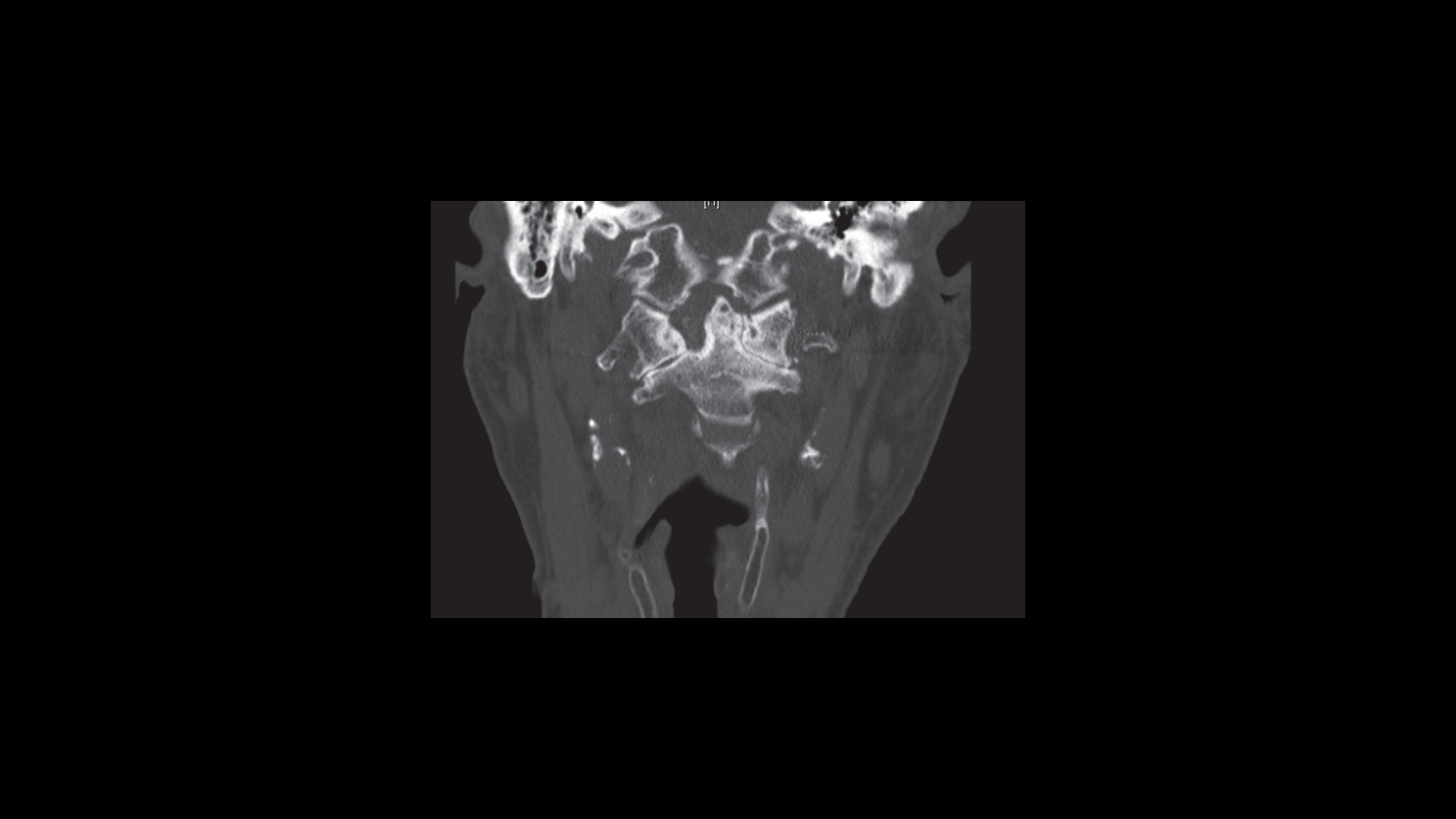 The use of SPECT/CT in a musculoskeletal Physical Medicine and ...