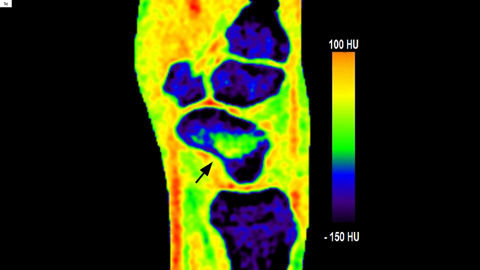 Scaphoid fracture associated bone marrow edema