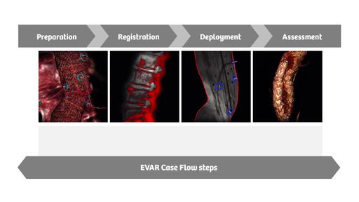 EVAR in the Hybrid OR