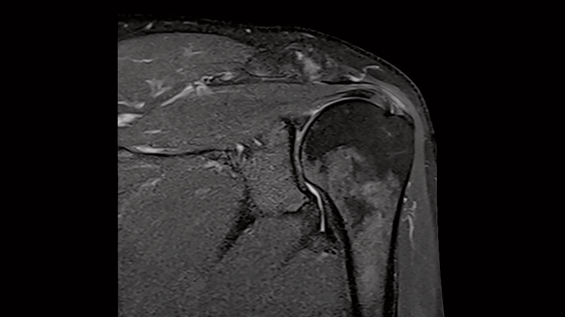 MAGNETOM Free.Max– Open Bore MRI