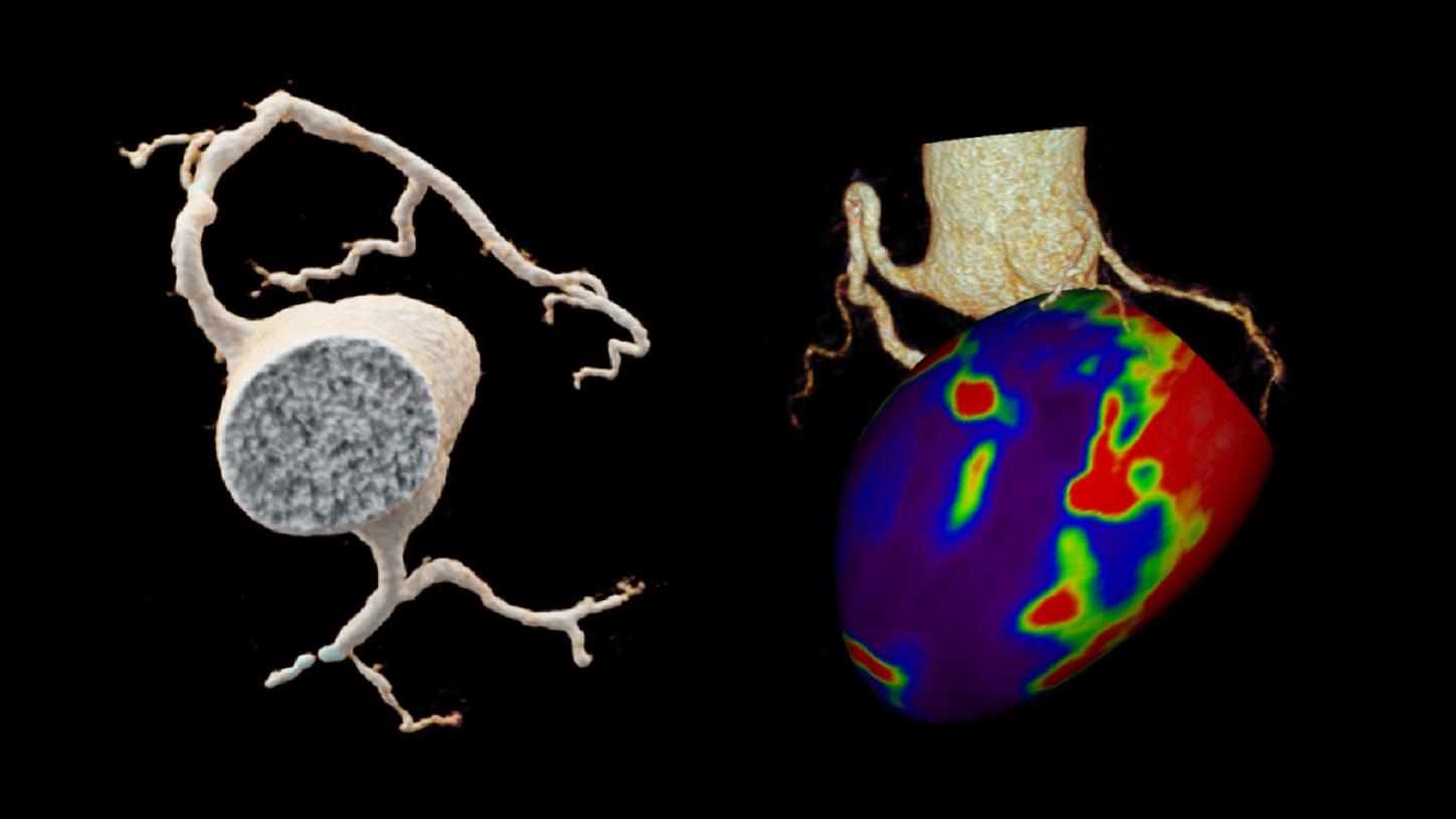 LAD occlusion – acute or chronic?