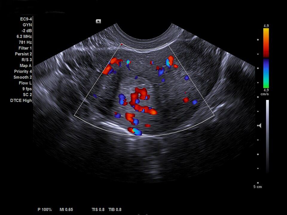 ACUSON NX2 Series Ultrasound System