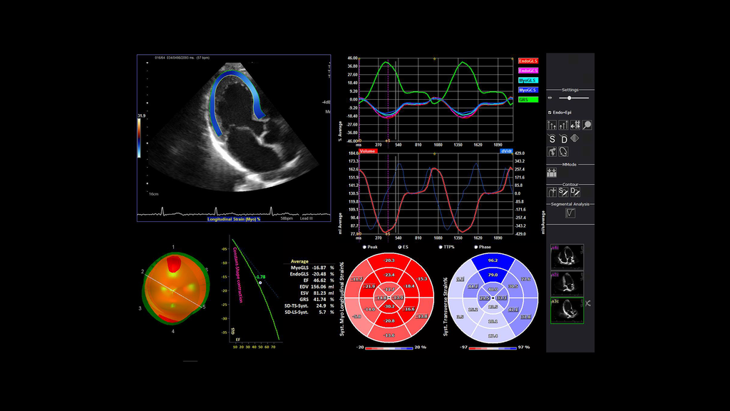 ACUSON Sequoia Ultrasound System