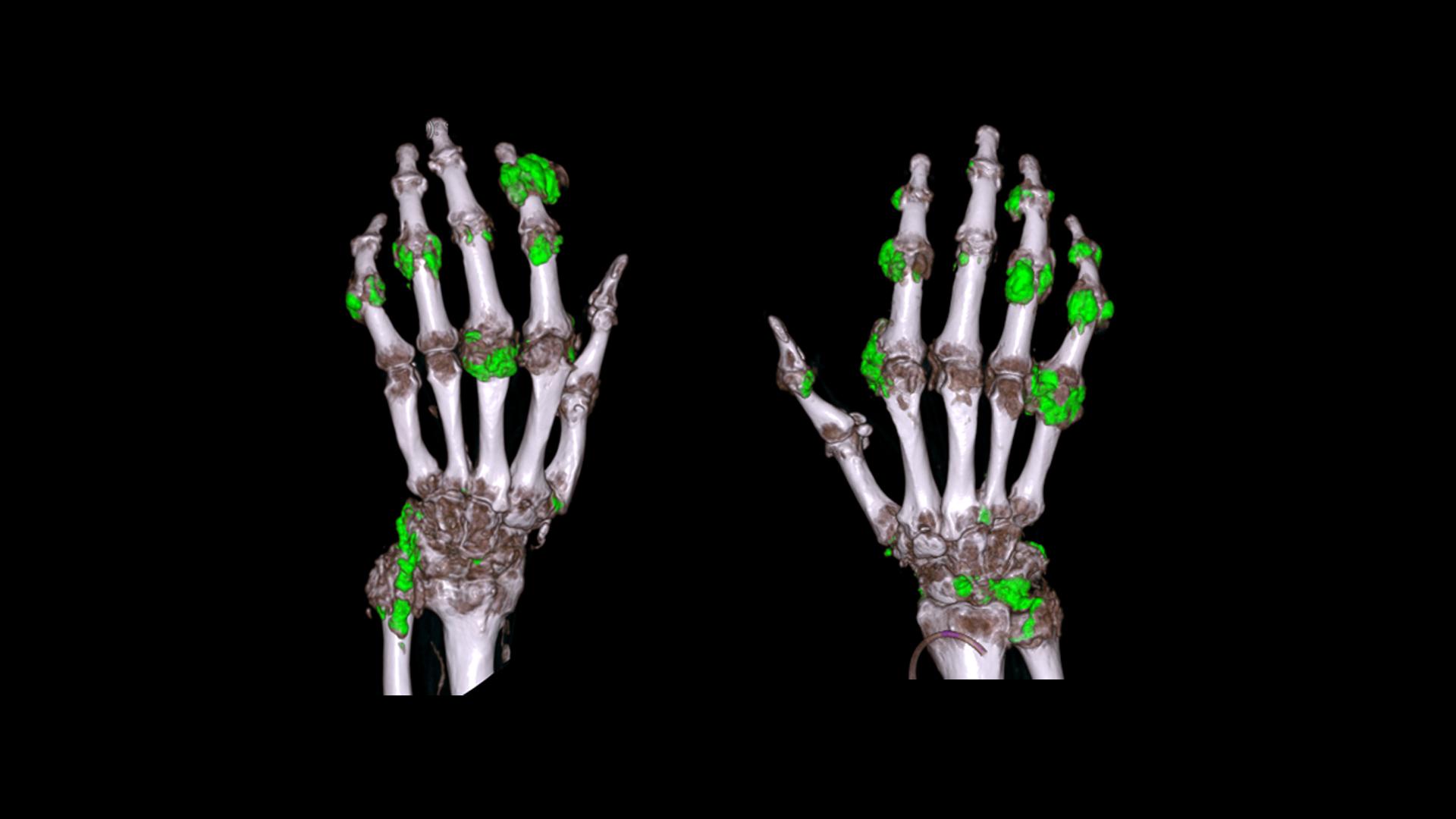 SOMATOM Definition Edge