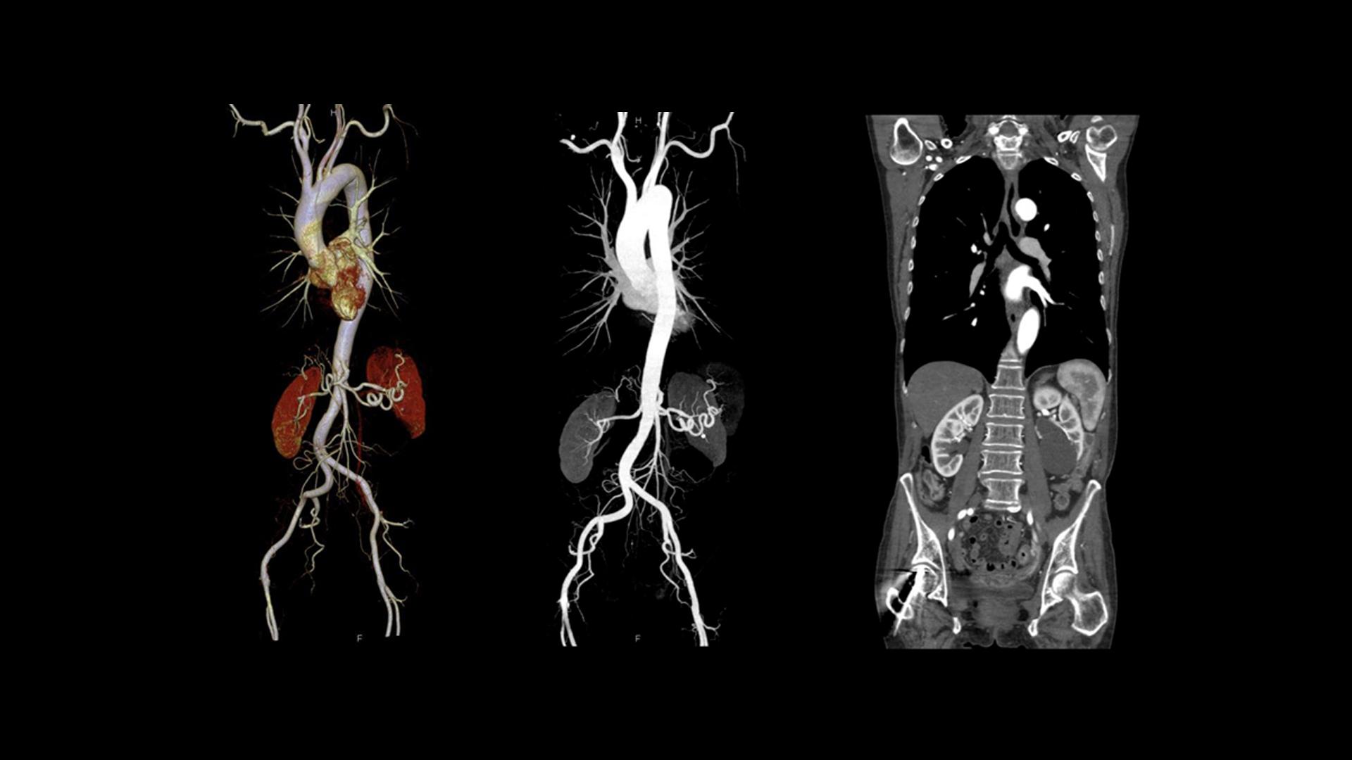 SOMATOM Definition Edge