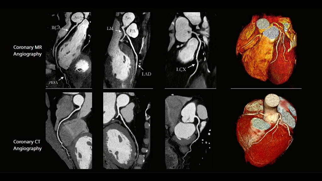 Coronary Artery Disease