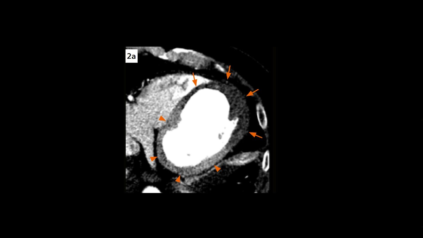 LAD occlusion – acute or chronic?