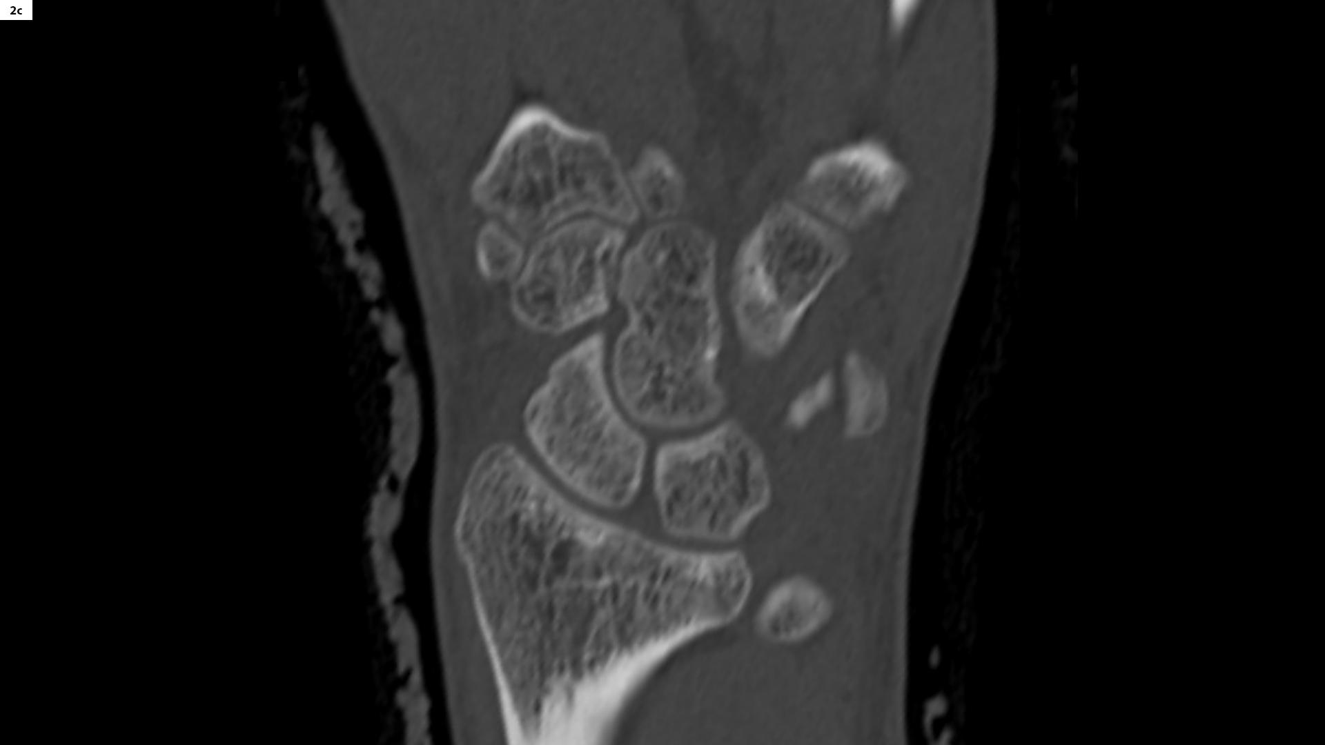 Scaphoid fracture associated bone marrow edema