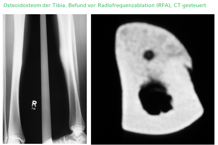MUM – Muskuloskelettales Universitätszentrum München | Osteoidosteom