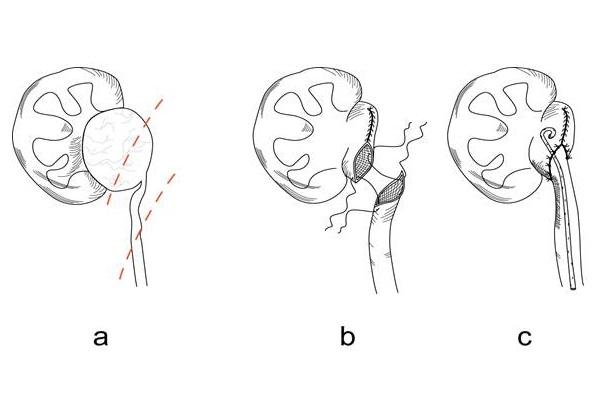 Ureterabgangsstenose | Kinderchirurgische Klinik und Poliklinik im Dr ...