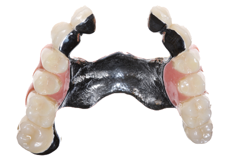 Herausnehmbarer Zahnersatz | Poliklinik für zahnärztliche Prothetik