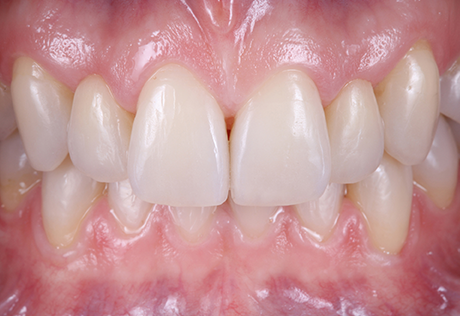 Festsitzender Zahnersatz | Poliklinik für zahnärztliche Prothetik