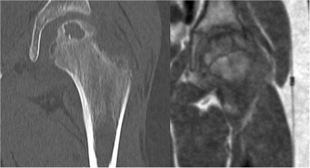 MUM – Muskuloskelettales Universitätszentrum München | Chondroblastom