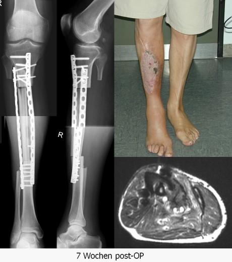 Knochenreplantation | MUM – Muskuloskelettales Universitätszentrum München