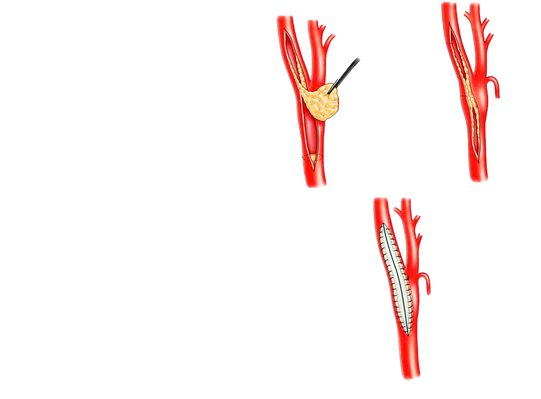 Carotischirurgie | Abteilung für Gefäßchirurgie