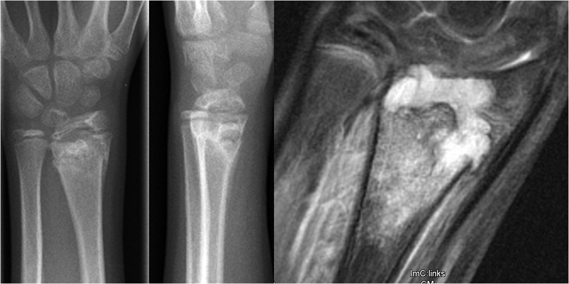 MUM – Muskuloskelettales Universitätszentrum München | Chondromyxoidfibrom