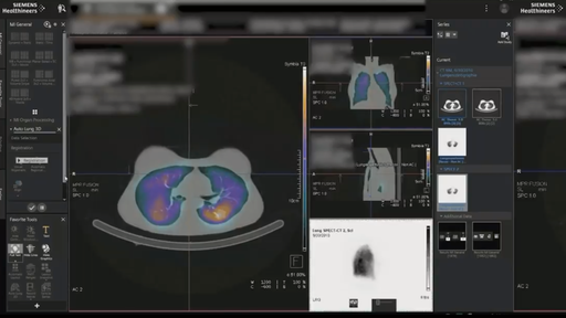 First Experiences with AI-supported 3D Lung Quantification¹