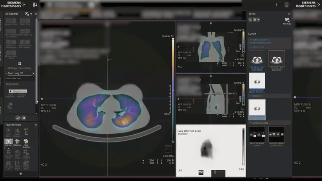 First Experiences With Ai Supported 3d Lung Quantification¹