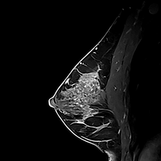 Nuts and Bolts of Breast Magnetic Resonance Imaging (MRI) interpretation