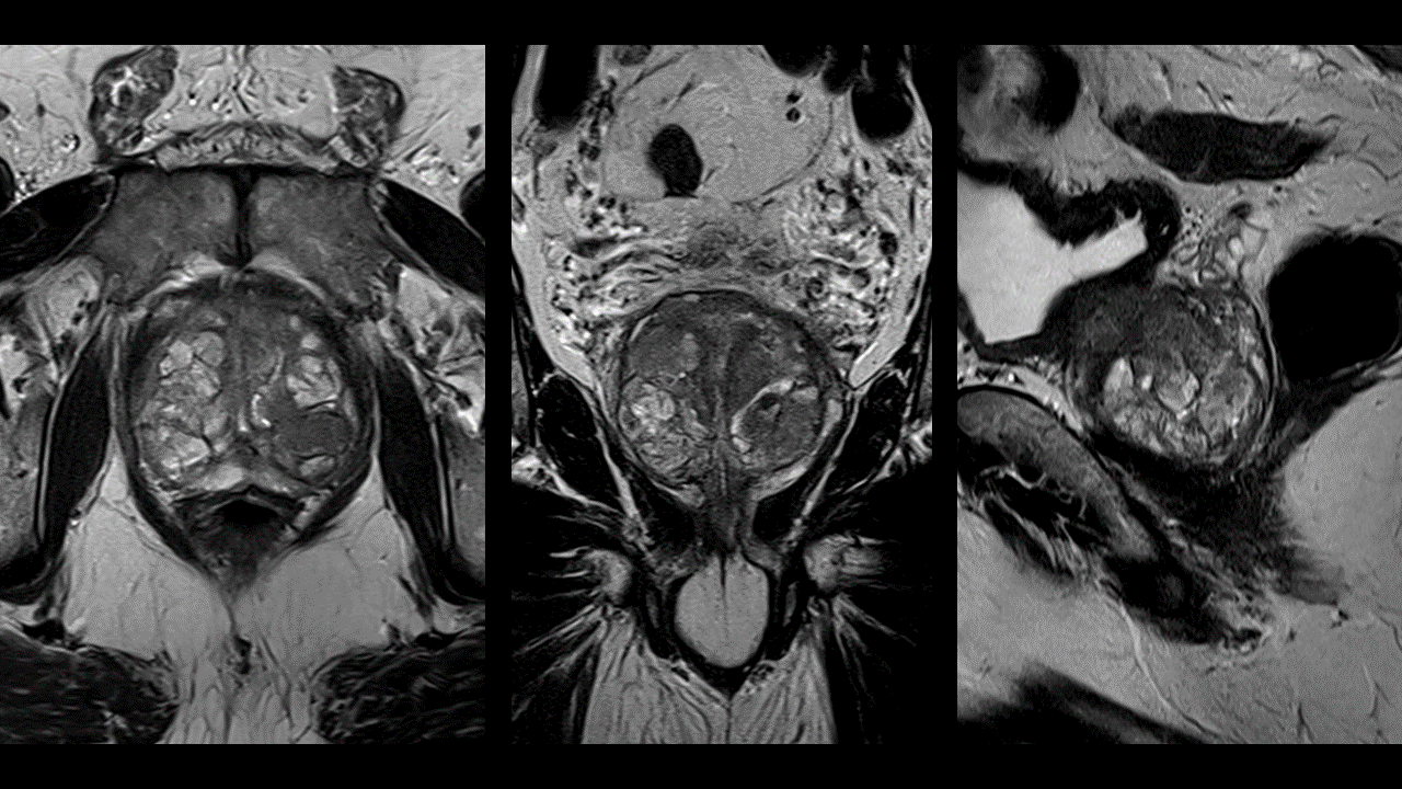 A practical approach to Prostate Magnetic Resonance Imaging (MRI) interpretation