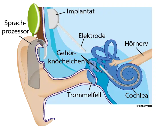 ⁣Cochlea-Implantat