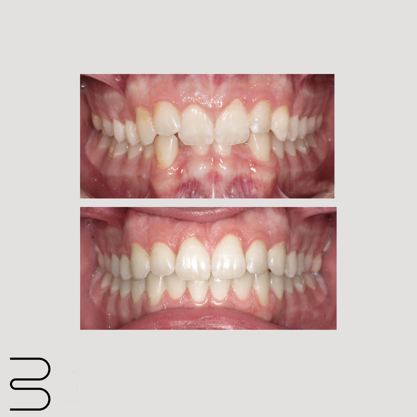 Invisalign Vor Und Nach Starkem Engstand