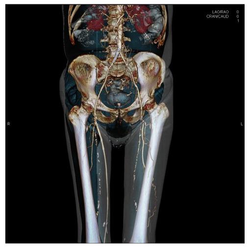 Run-Off with Stent and Bypass