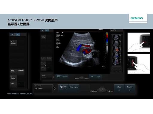 ACUSON P500超高档便携超声系统-西门子医疗系统有限公司