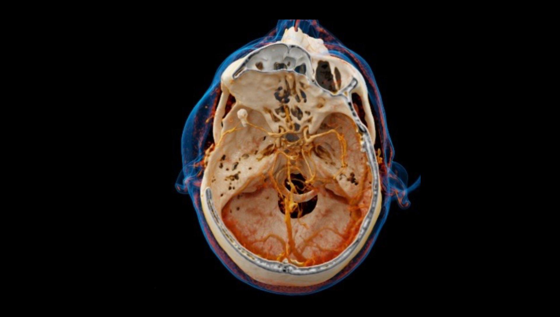 卒中救治，领先一步